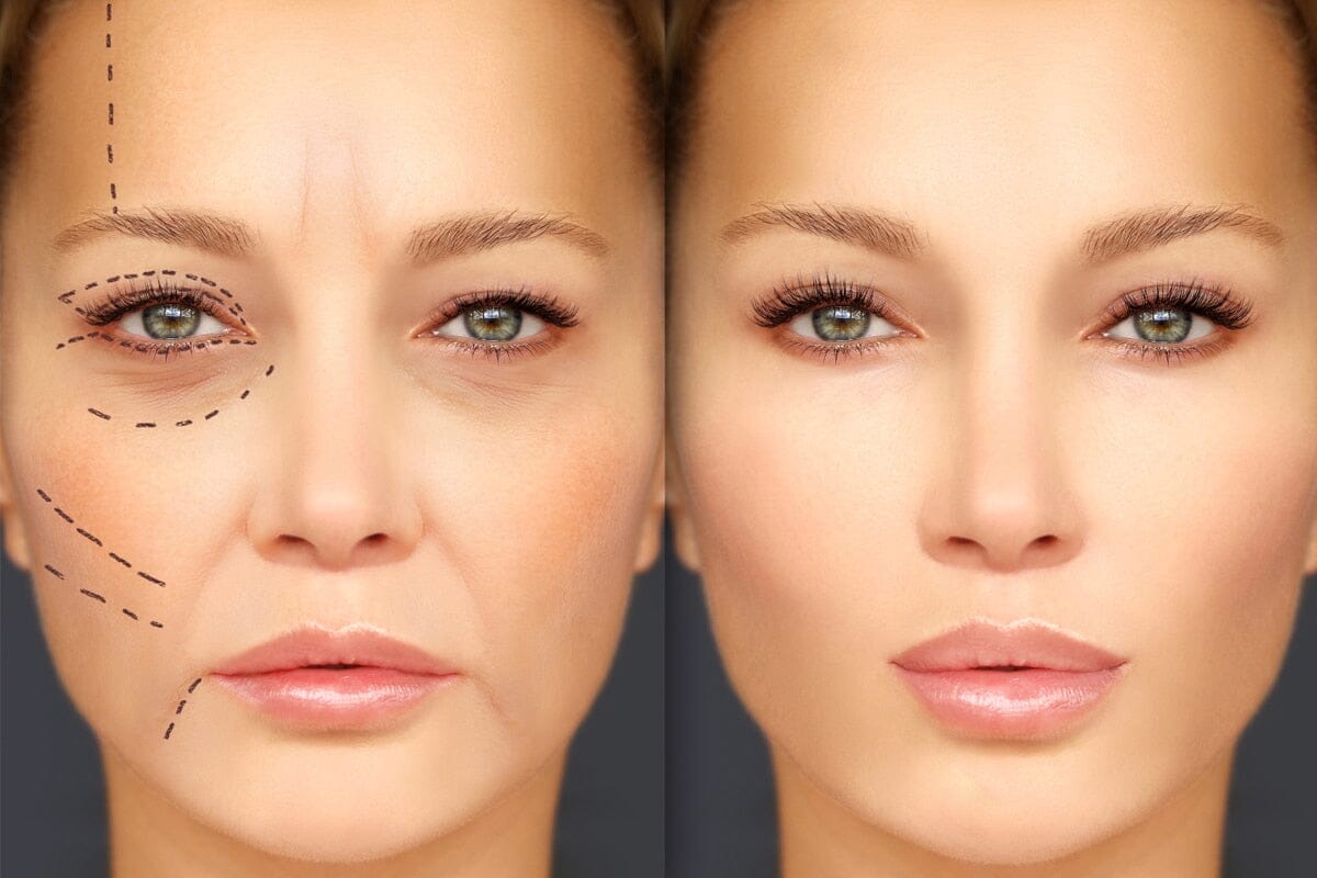 Aging Gracefully: How Dermal Fillers Can Help You Look Like the Best V – 1stopfiller.com